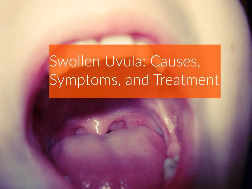 Swollen Uvula - Causes, Symptoms, and Treatment - The Healthy Apron