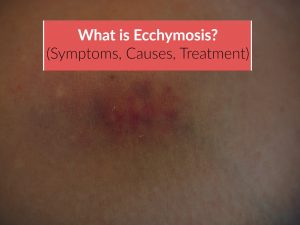 What is Ecchymosis? (Definition, Symptoms, Causes, Treatment)