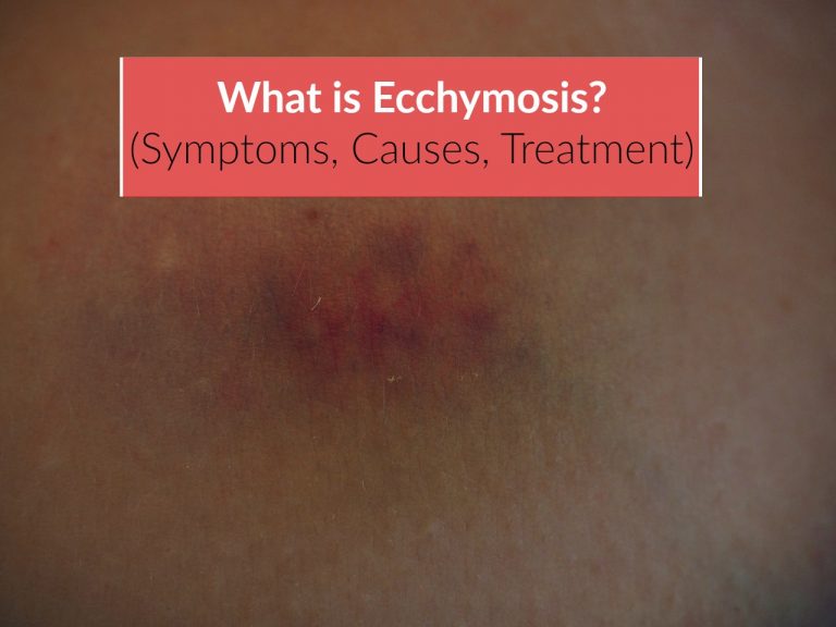 What is Ecchymosis? (Definition, Symptoms, Causes, Treatment)