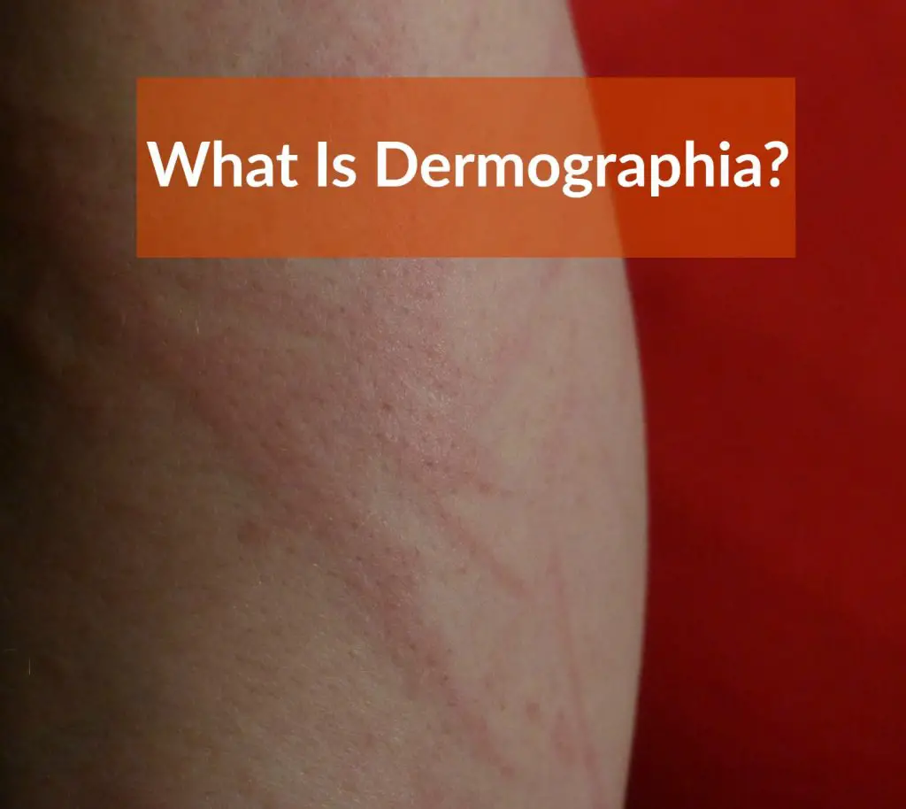 Dermographia (Dermographism-Causes,Symptoms,Treatment)