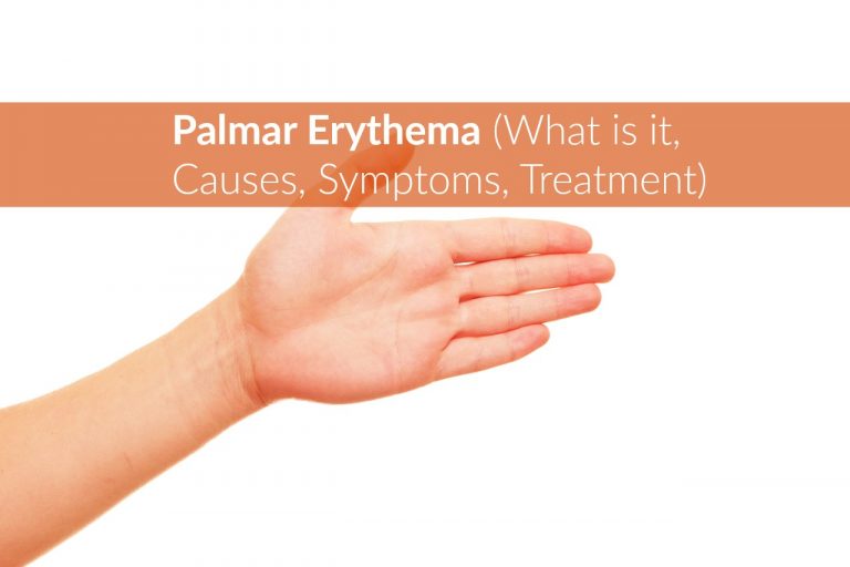 Palmar Erythema (What is it, Causes, Symptoms, Treatment) - The Healthy ...