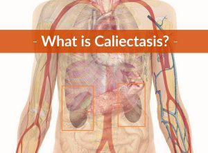 What is Caliectasis (Hydrocalycosis)? Causes,Treatment...