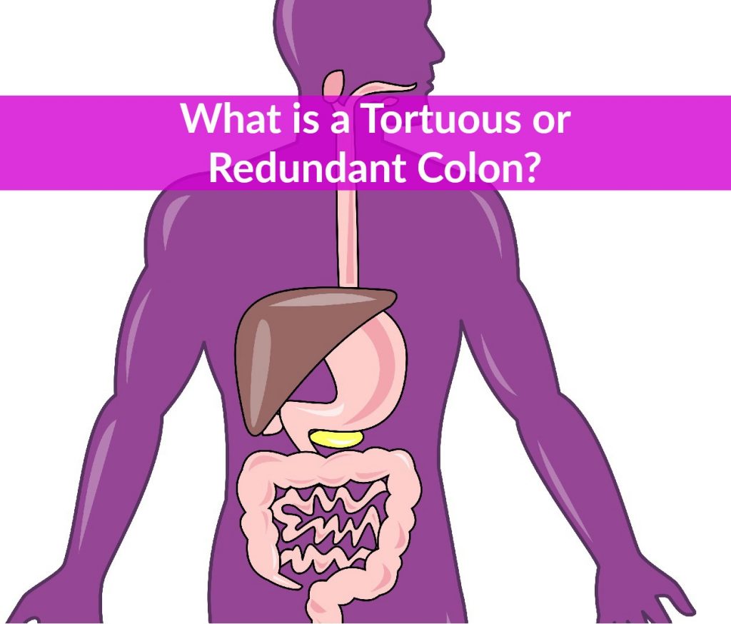 Tortuous Colon: Diet, Symptoms, Diagnosis, Treatment