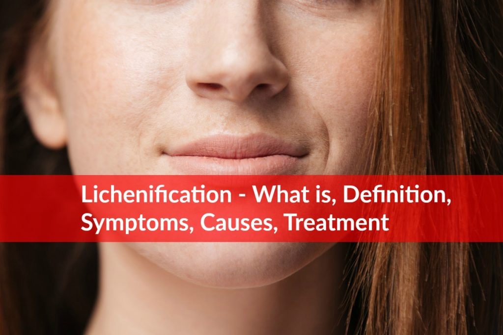 Lichenification - What is, Definition, Causes, Treatment...