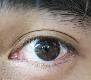 Pingueculitis - Why It Happens And How It Is Treated? - The Healthy Apron